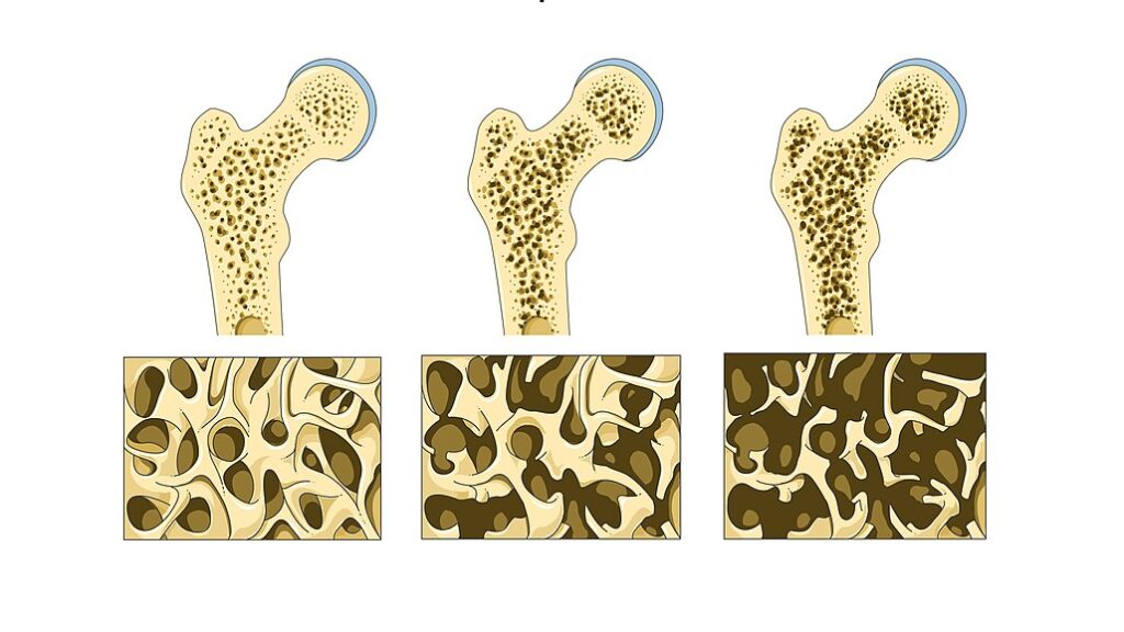 Heat And Gut Microbiota Promote Stronger Bones | SurgMedia