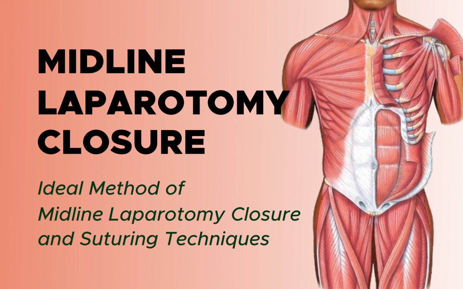 Continuous Midline Laparotomy Closure: Suture Techniques | SurgMedia