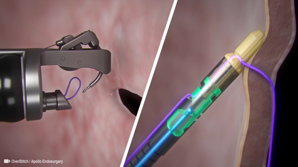 Single Channel Endoscopic Suturing System | SurgMedia