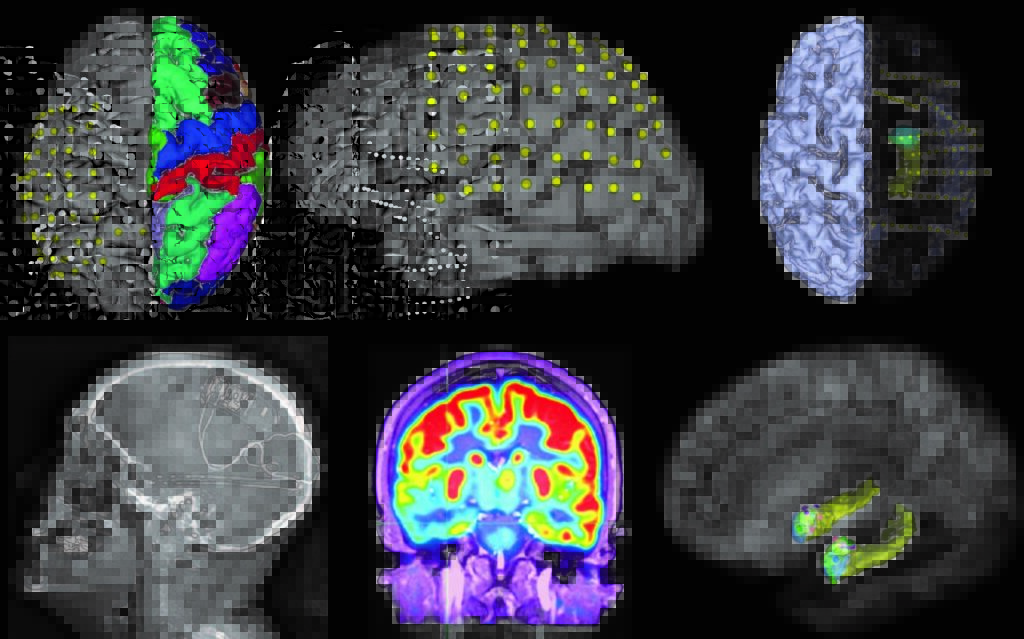 Early Warning of Seizures Can Be Groundbreaking for Epilepsy Patients ...