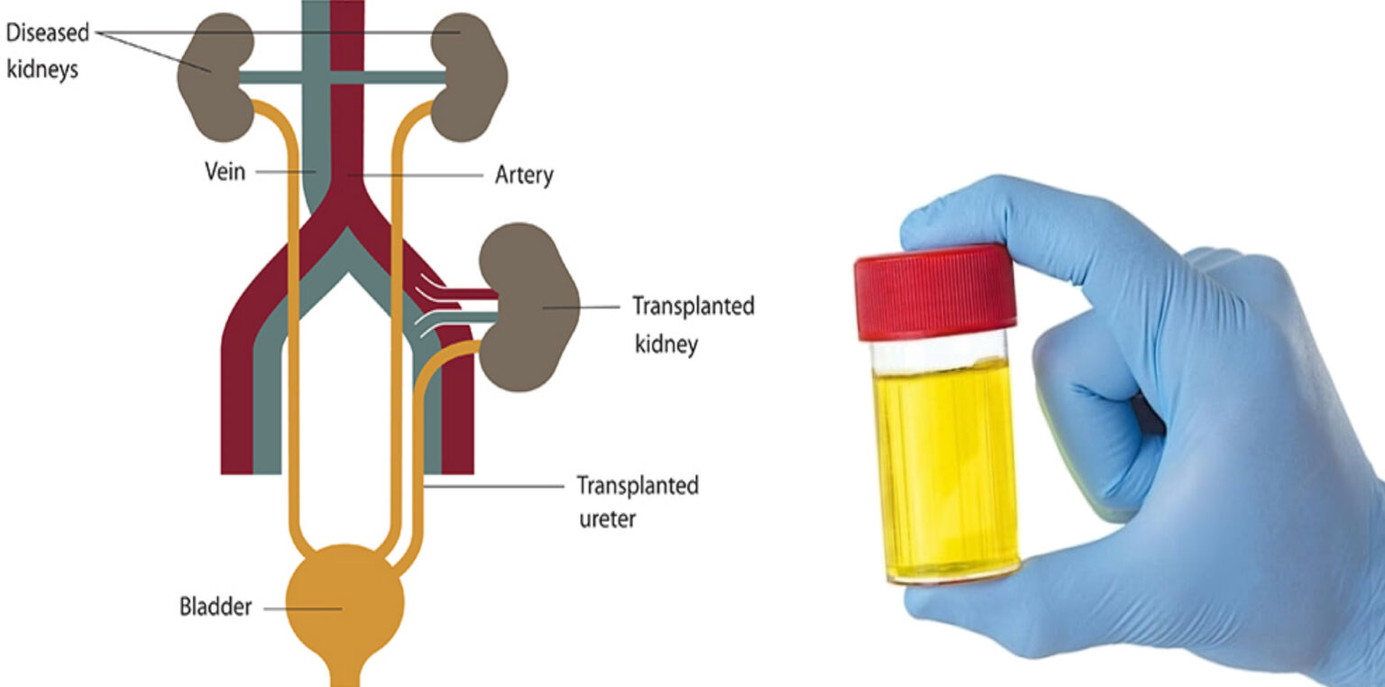 Novel Urine Based Test for the Detection of Kidney Transplant Rejection ...