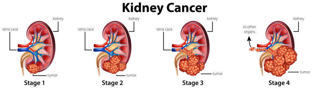 Renal Cancer: Types of Kidney Cancer | SurgMedia