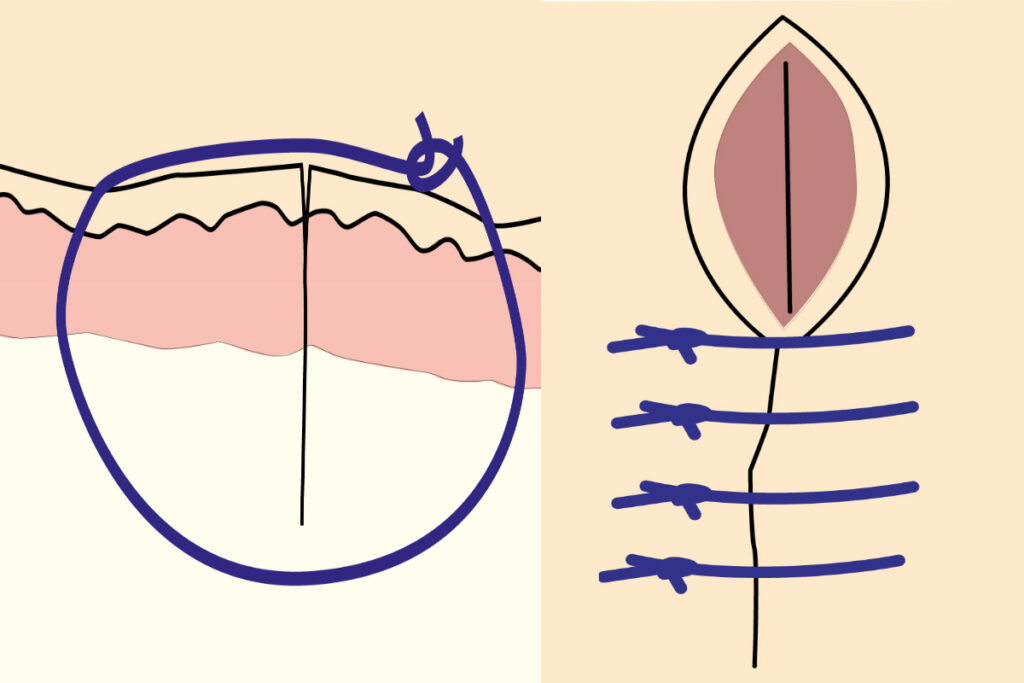 Common Suture Patterns | SurgMedia