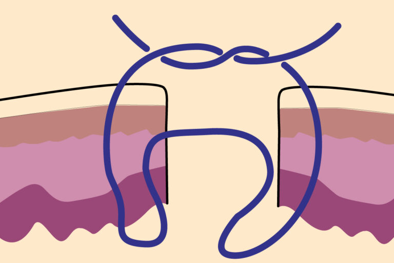 Common Suture Patterns | SurgMedia