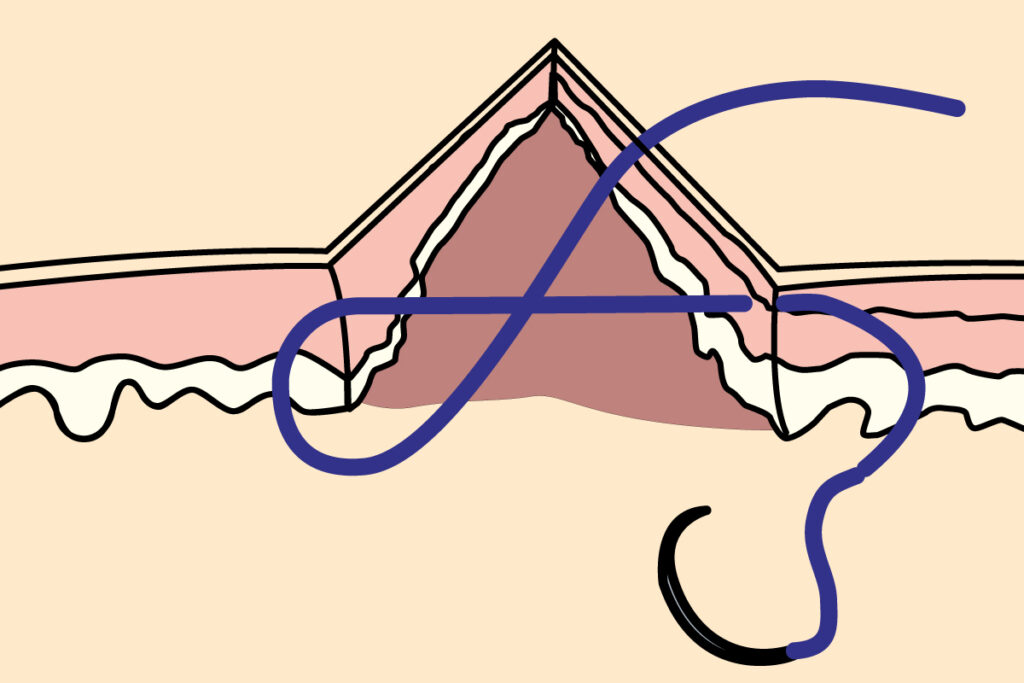 Common Suture Patterns | SurgMedia