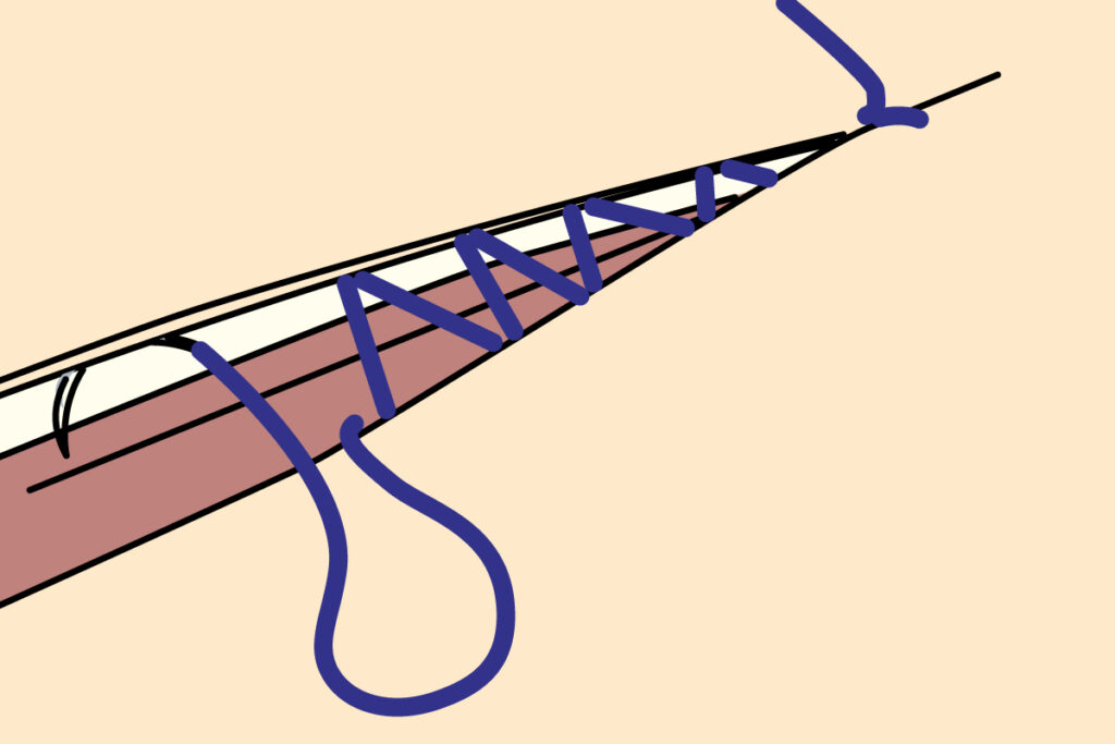 Common Suture Patterns | SurgMedia