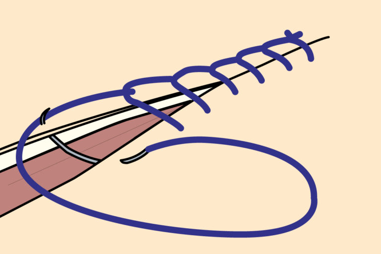Common Suture Patterns | SurgMedia