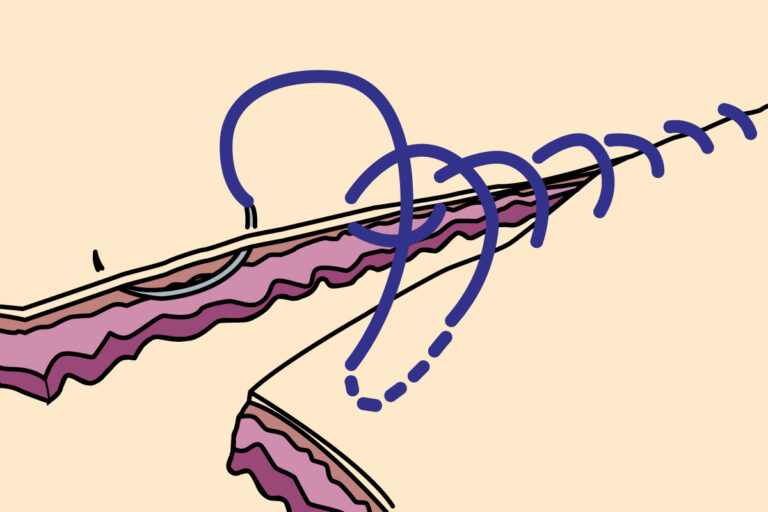 Common Suture Patterns | SurgMedia