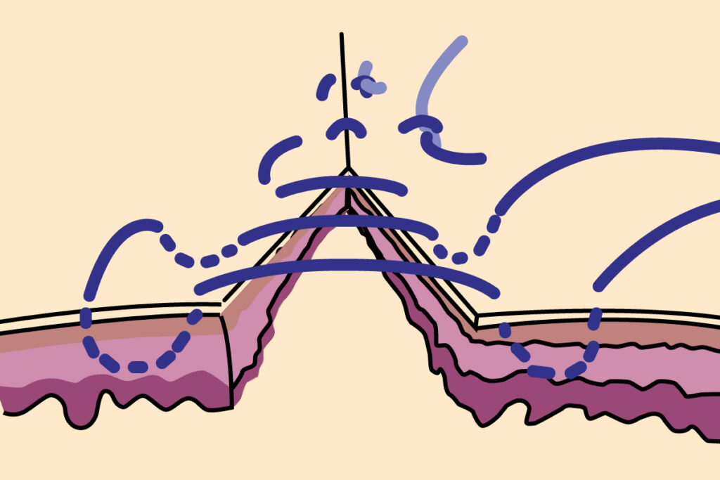 Common Suture Patterns | SurgMedia