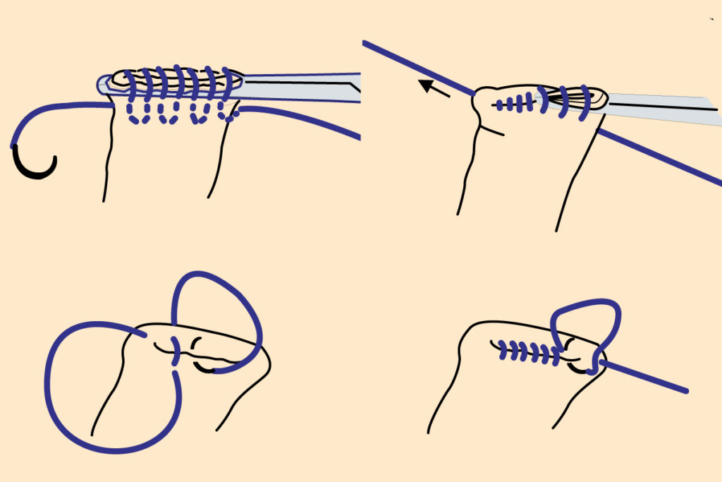 Common Suture Patterns | SurgMedia