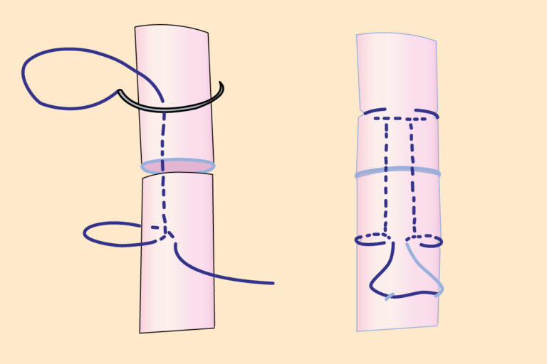 Common Suture Patterns | SurgMedia