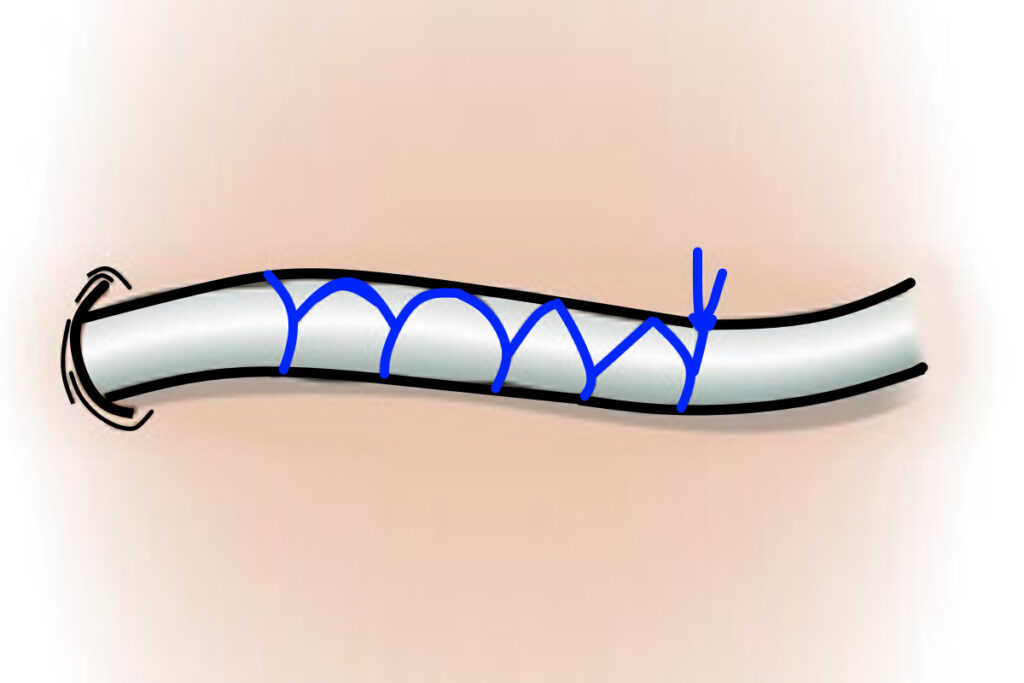Common Suture Patterns | SurgMedia