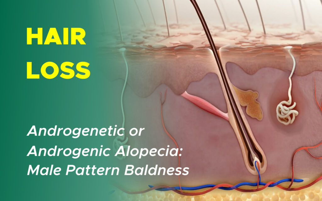 Male Pattern Hair Loss: Androgenetic Alopecia | SurgMedia