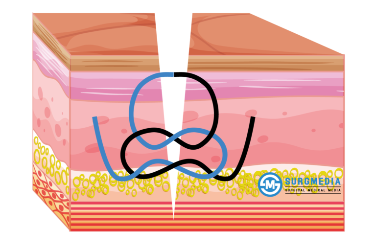 Common Surgical Knot Types | SurgMedia