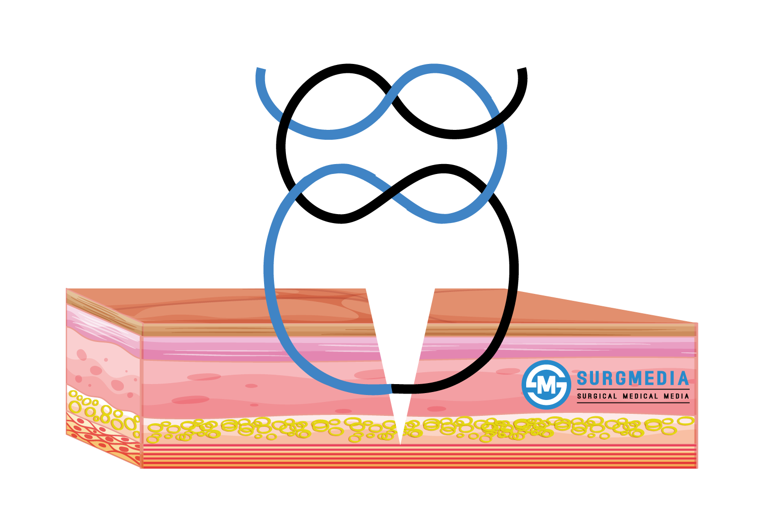 Common Surgical Knot Types | SurgMedia